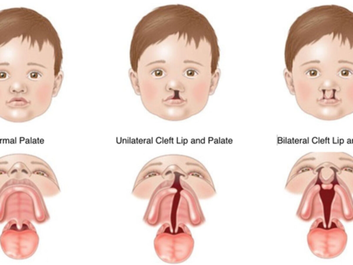 Are There Diffe Types Of Cleft Lip And Palate Repair Infoupdate Are There Diffe Types Of Cleft Lip And Palate Repair Infoupdate