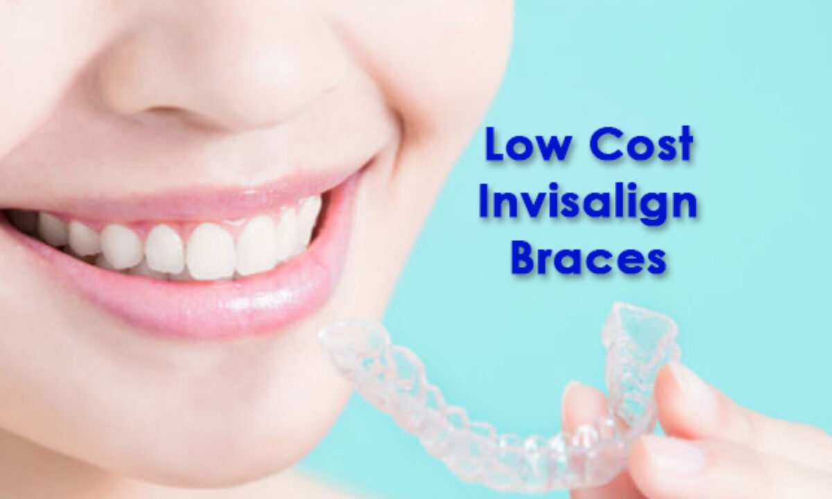 Invisalign Cost Average Cost Of Invisalign Clear Aligners