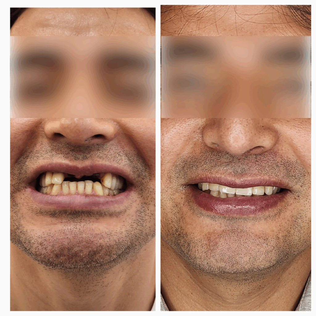Get your RCT done in 60 to 90 minutes!! At Dr Bhutani Dental clinc|